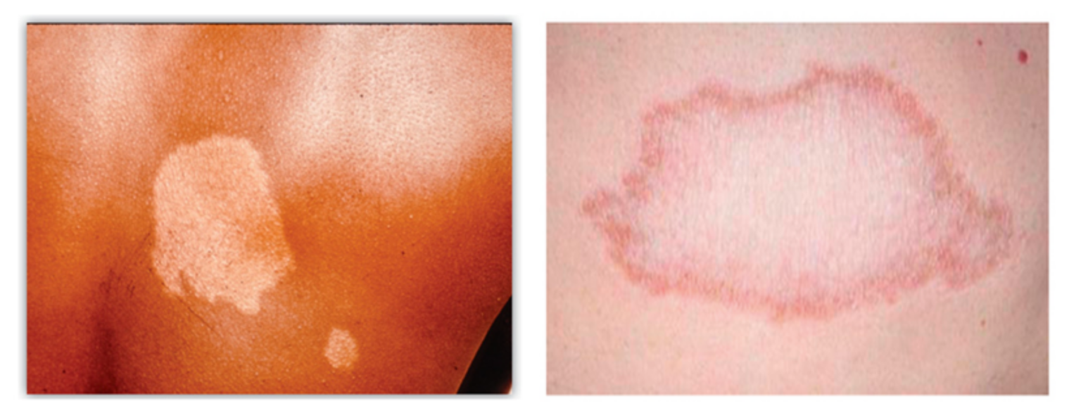 Kenali Kusta: Penyakit Kulit yang Bisa Disembuhkan | Rumah Sakit ...